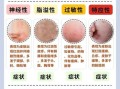 皮肤病图片对照大全_如何快速识别常见皮肤病