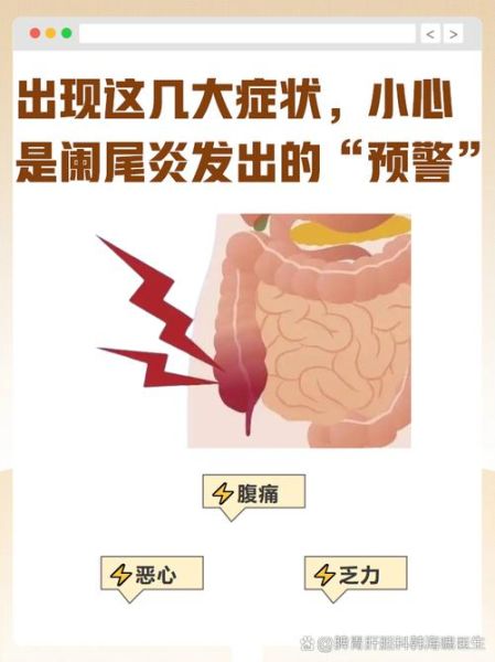 女性阑尾炎早期症状有哪些_女性阑尾炎和月经痛区别-第3张图片-山城妙识