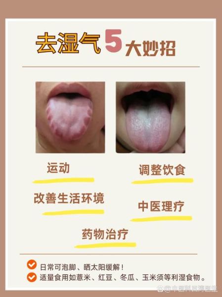 男人湿毒太重十大表现_如何快速祛湿-第3张图片-山城妙识 男人湿毒太重十大表现_如何快速祛湿-第3张图片-山城妙识