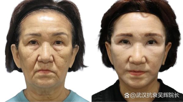 面部拉皮的最佳年龄_面部拉皮适合多大年龄-第1张图片-山城妙识 面部拉皮的最佳年龄_面部拉皮适合多大年龄-第1张图片-山城妙识