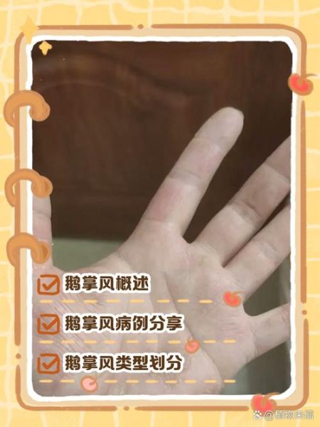 鹅掌风是怎么引起的_鹅掌风病因有哪些-第3张图片-山城妙识 鹅掌风是怎么引起的_鹅掌风病因有哪些-第3张图片-山城妙识