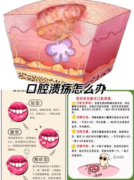 口腔溃疡怎么快速好_治口腔溃疡六个小偏方-第3张图片-山城妙识 口腔溃疡怎么快速好_治口腔溃疡六个小偏方-第3张图片-山城妙识