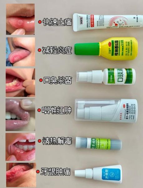 口腔溃疡怎么快速好_治口腔溃疡六个小偏方-第1张图片-山城妙识 口腔溃疡怎么快速好_治口腔溃疡六个小偏方-第1张图片-山城妙识