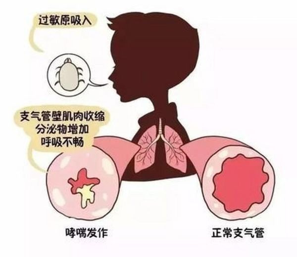 过敏性支气管哮喘的最佳治疗方法_如何根治不复发-第2张图片-山城妙识 过敏性支气管哮喘的最佳治疗方法_如何根治不复发-第2张图片-山城妙识