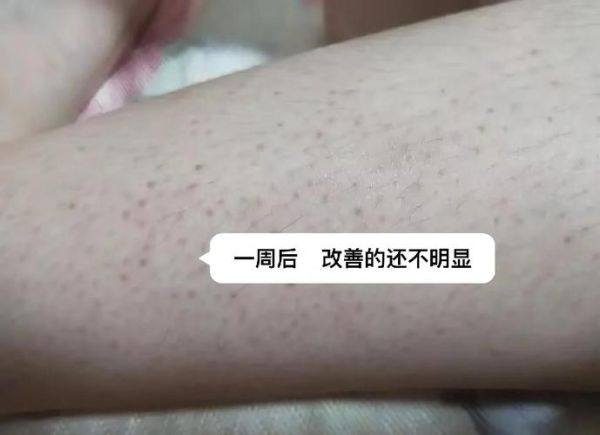 口服维生素a鸡皮肤多久见效_口服维生素a鸡皮肤好了是真的吗-第3张图片-山城妙识 口服维生素a鸡皮肤多久见效_口服维生素a鸡皮肤好了是真的吗-第3张图片-山城妙识