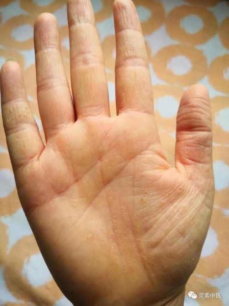 鹅掌风用醋泡多久能好_醋泡鹅掌风正确方法-第2张图片-山城妙识 鹅掌风用醋泡多久能好_醋泡鹅掌风正确方法-第2张图片-山城妙识