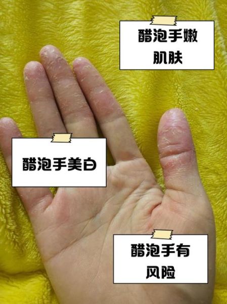 鹅掌风用醋泡多久能好_醋泡鹅掌风正确方法-第1张图片-山城妙识 鹅掌风用醋泡多久能好_醋泡鹅掌风正确方法-第1张图片-山城妙识