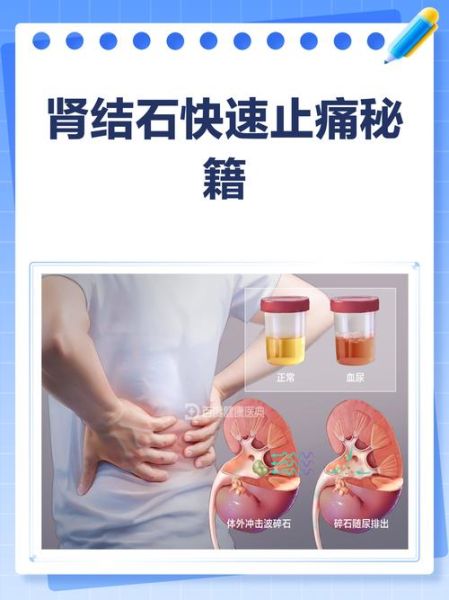 肾结石怎么治疗最好_肾结石最佳治疗方案-第1张图片-山城妙识