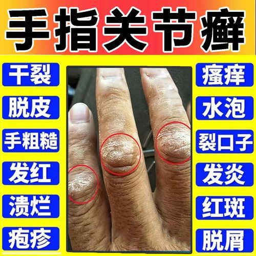 鹅掌风用什么药效果最好_鹅掌风擦什么药膏好得快-第1张图片-山城妙识 鹅掌风用什么药效果最好_鹅掌风擦什么药膏好得快-第1张图片-山城妙识