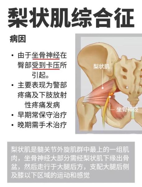 梨状肌位置在哪_梨状肌疼痛怎么缓解-第2张图片-山城妙识