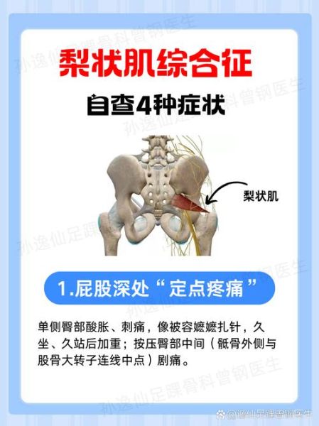 梨状肌位置在哪_梨状肌疼痛怎么缓解-第3张图片-山城妙识