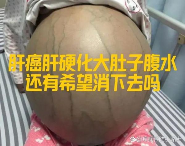 肝硬化能活多久_肝硬化晚期症状有哪些-第2张图片-山城妙识