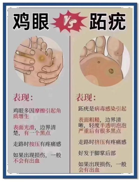 鸡眼和跖疣的区别_怎么区分鸡眼和跖疣-第2张图片-山城妙识