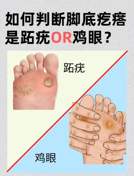 鸡眼和跖疣的区别_怎么区分鸡眼和跖疣-第1张图片-山城妙识