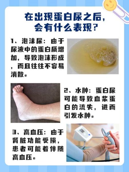 蛋白尿是什么症状_蛋白尿能自愈吗-第2张图片-山城妙识