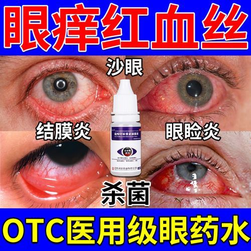 过敏性结膜炎症状有哪些_如何快速缓解眼睛痒-第3张图片-山城妙识