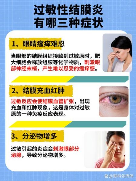 过敏性结膜炎症状有哪些_如何快速缓解眼睛痒-第2张图片-山城妙识
