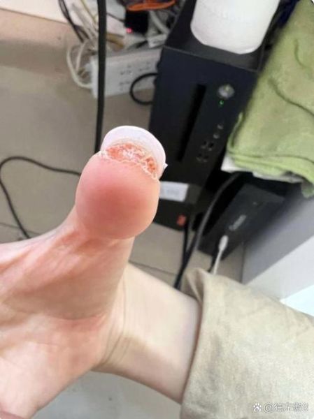 空手指图片是什么_空手指图片怎么去除-第2张图片-山城妙识 空手指图片是什么_空手指图片怎么去除-第2张图片-山城妙识