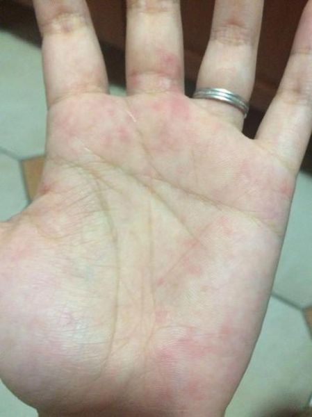 鹅掌风初期图片_如何辨别早期症状-第1张图片-山城妙识 鹅掌风初期图片_如何辨别早期症状-第1张图片-山城妙识