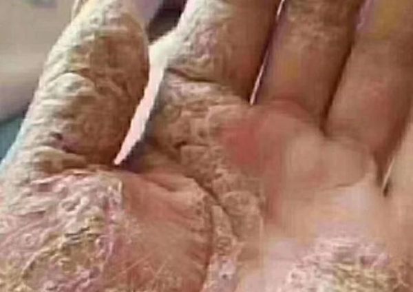 鹅掌风初期图片_如何辨别早期症状-第3张图片-山城妙识 鹅掌风初期图片_如何辨别早期症状-第3张图片-山城妙识