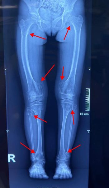 骨肉瘤能治愈吗_早期骨肉瘤治愈率有多高-第1张图片-山城妙识