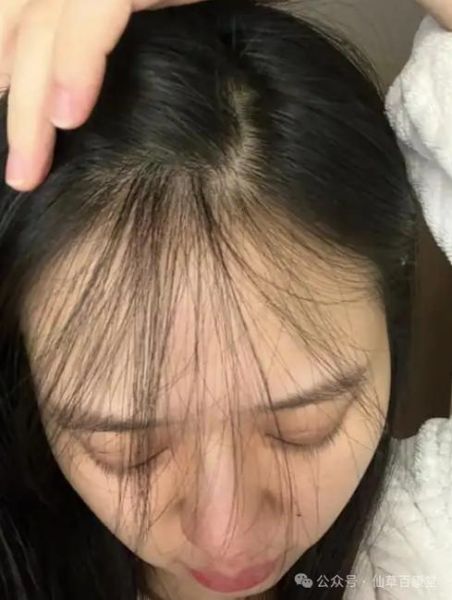 女性掉头发严重怎么办_治疗女性掉头发小妙招-第3张图片-山城妙识