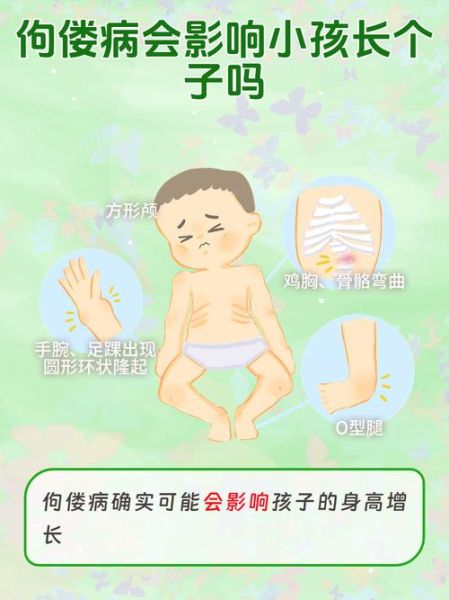 轻微佝偻病图片_早期症状识别-第3张图片-山城妙识
