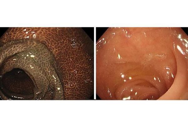 酵素吃出黑肠子_黑肠子真相-第1张图片-山城妙识