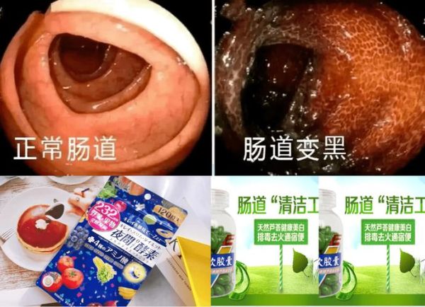 酵素吃出黑肠子_黑肠子真相-第2张图片-山城妙识
