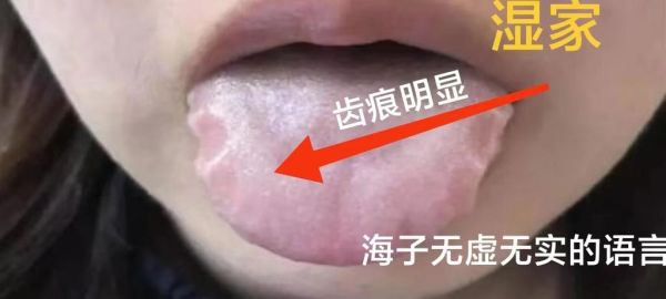 麻黄加术汤的功效与作用_麻黄加术汤适合什么人-第3张图片-山城妙识