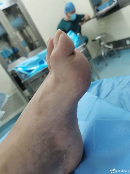 马蹄足是什么病_马蹄足能治好吗-第3张图片-山城妙识 马蹄足是什么病_马蹄足能治好吗-第3张图片-山城妙识