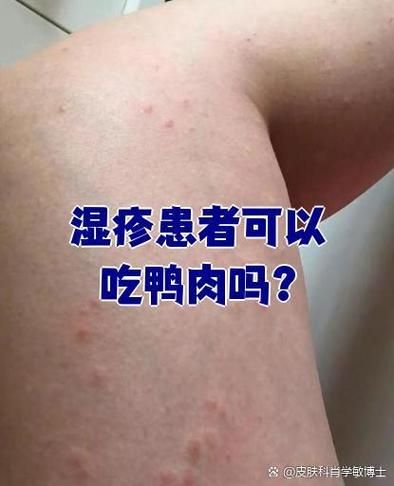 鸭肉是发物吗_皮肤病能吃吗-第3张图片-山城妙识