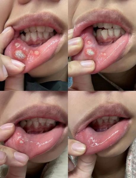 口疮反复发作怎么办_老偏方治口疮真的有效吗-第2张图片-山城妙识 口疮反复发作怎么办_老偏方治口疮真的有效吗-第2张图片-山城妙识