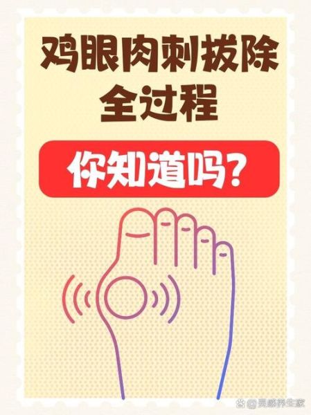 鸡眼自己脱落小妙招_鸡眼自然脱落需要多久-第2张图片-山城妙识 鸡眼自己脱落小妙招_鸡眼自然脱落需要多久-第2张图片-山城妙识