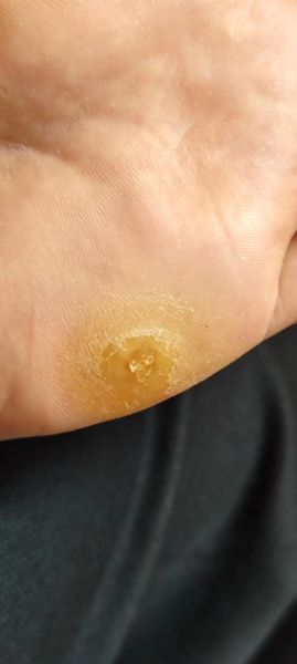 鸡眼自己脱落小妙招_鸡眼自然脱落需要多久-第3张图片-山城妙识 鸡眼自己脱落小妙招_鸡眼自然脱落需要多久-第3张图片-山城妙识