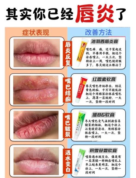 香肠嘴是怎么引起的_嘴唇突然肿厚怎么办-第2张图片-山城妙识