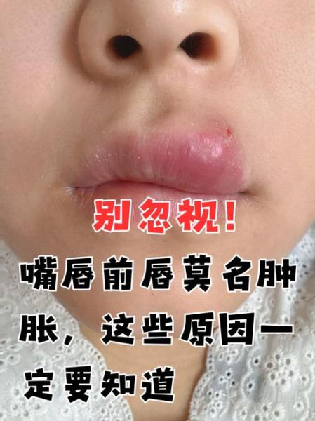 香肠嘴是怎么引起的_嘴唇突然肿厚怎么办-第1张图片-山城妙识
