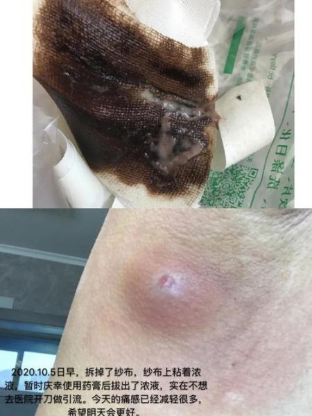 疖子怎么治_疖子几天能好-第1张图片-山城妙识 疖子怎么治_疖子几天能好-第1张图片-山城妙识