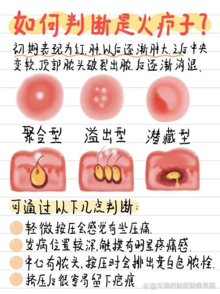 疖子怎么治_疖子几天能好-第3张图片-山城妙识 疖子怎么治_疖子几天能好-第3张图片-山城妙识