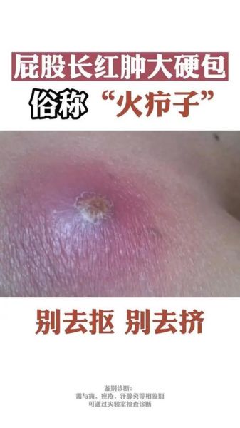 疖子怎么治_疖子几天能好-第2张图片-山城妙识 疖子怎么治_疖子几天能好-第2张图片-山城妙识