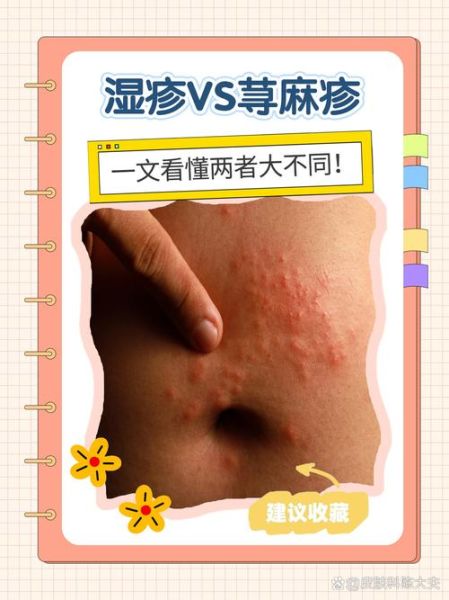 过敏和湿疹的区别图片_如何一眼分辨-第2张图片-山城妙识