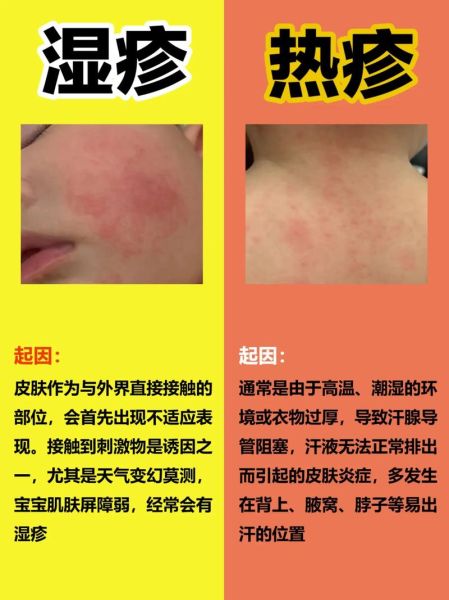 过敏和湿疹的区别图片_如何一眼分辨-第3张图片-山城妙识