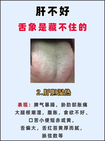 肝胆湿热吃什么药效果最好_肝胆湿热中成药推荐-第2张图片-山城妙识 肝胆湿热吃什么药效果最好_肝胆湿热中成药推荐-第2张图片-山城妙识