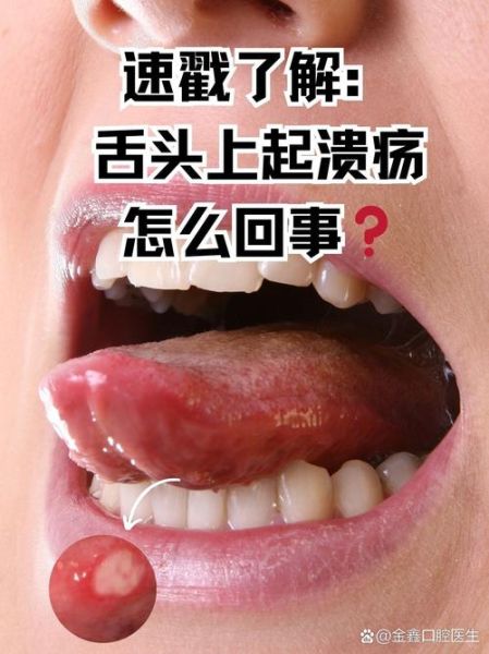 舌头溃疡一夜见效偏方_怎么快速止痛-第1张图片-山城妙识
