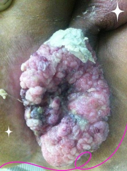 菜花状疣体初期症状_会传染吗-第1张图片-山城妙识