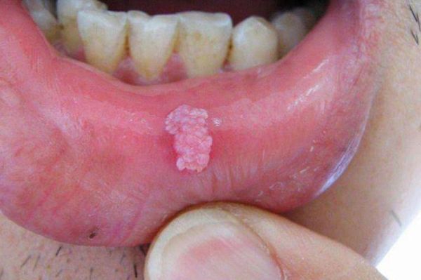 菜花状疣体初期症状_会传染吗-第3张图片-山城妙识