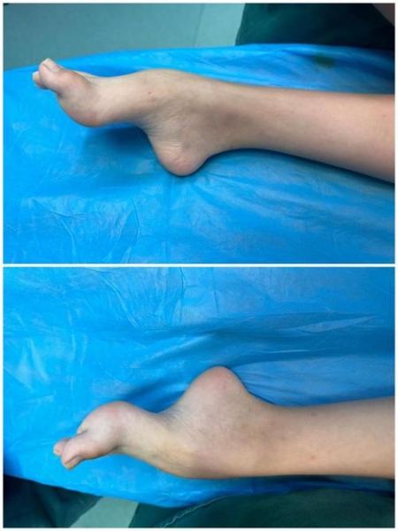 马蹄足是怎么引起的_马蹄足形成原因-第3张图片-山城妙识