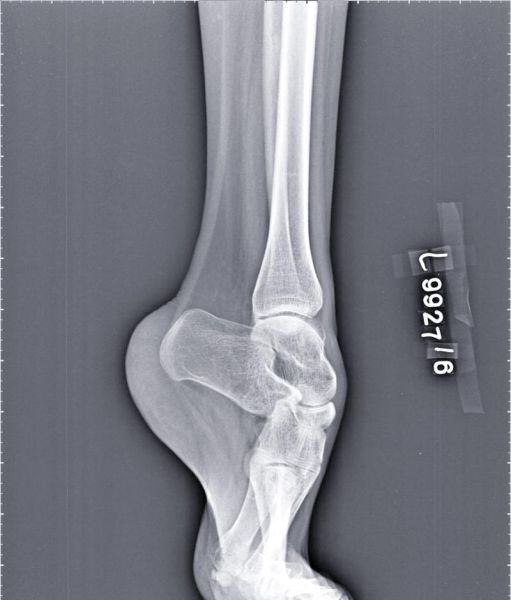 马蹄足是怎么引起的_马蹄足形成原因-第2张图片-山城妙识