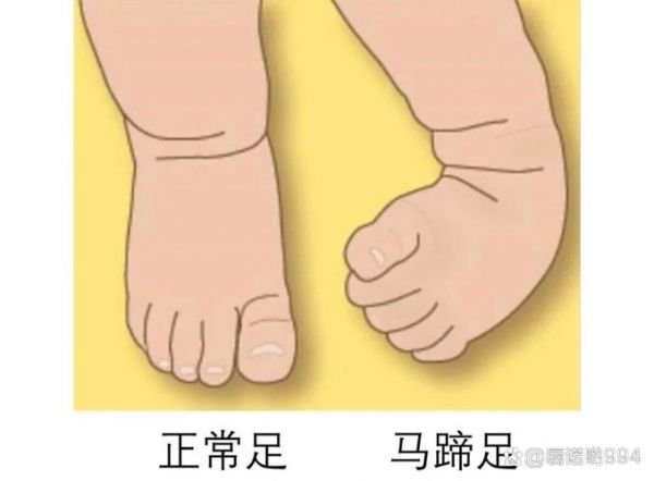 马蹄足是怎么引起的_马蹄足形成原因-第1张图片-山城妙识