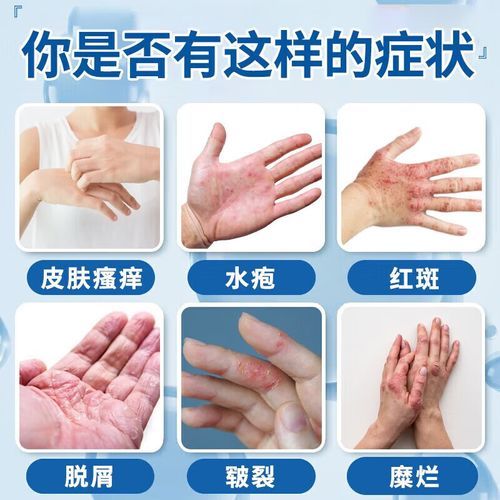 鹅掌风怎么治疗_鹅掌风用什么药膏-第1张图片-山城妙识